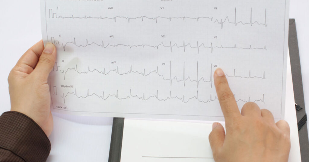How To Read An EKG/ECG Wave? PQRST Wave Explained